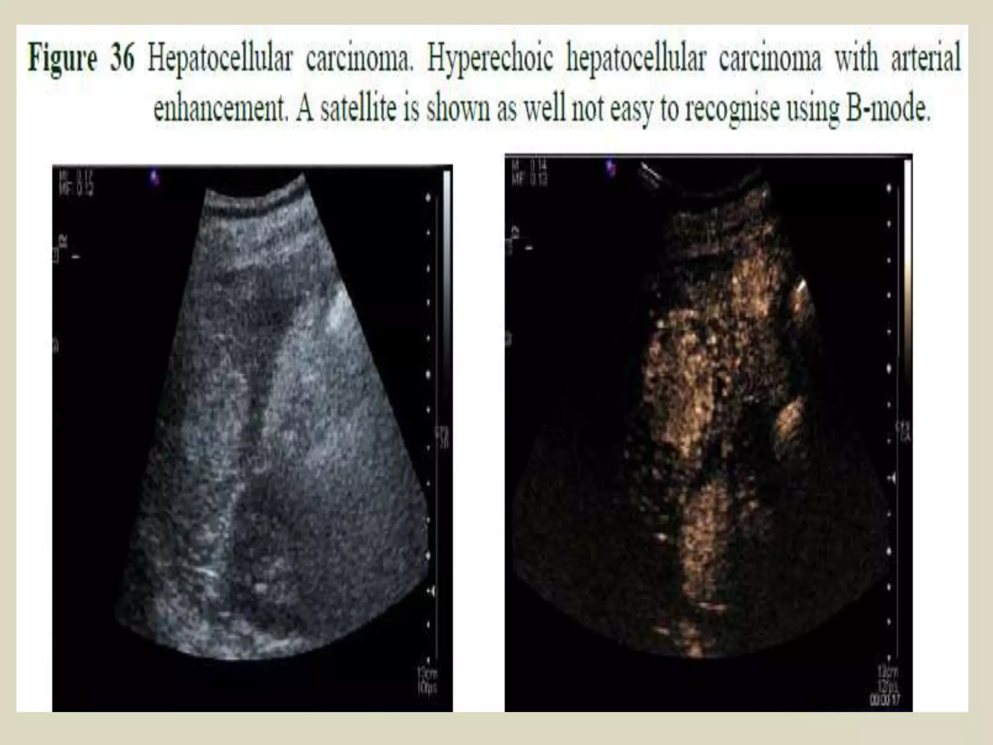Presentation1.pptx, ultrasound examination of the liver and gall ...