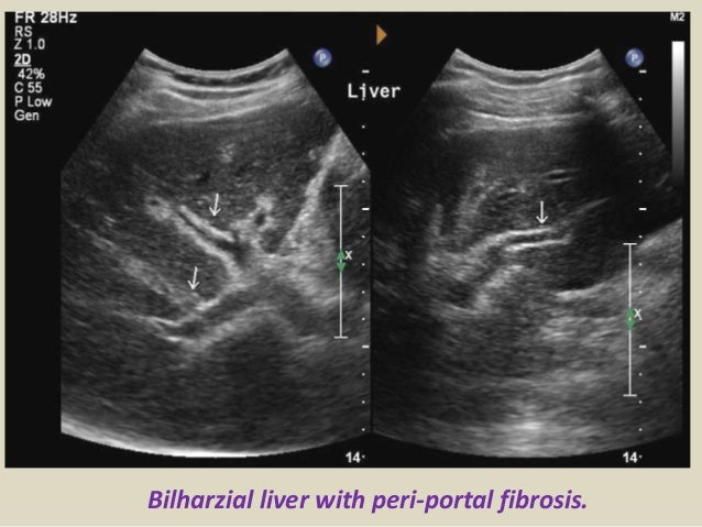 Presentation1.pptx, ultrasound examination of the liver and gall blad…