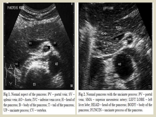 Presentation1.pptx, ultrasound study of the spleen and pancreas. | PPT