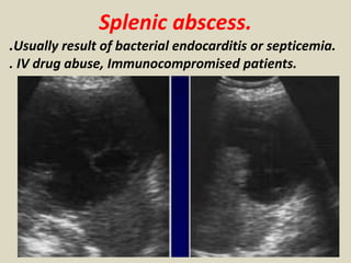 Pancreatic Abscess Ultrasound