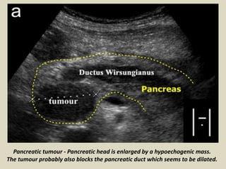Abnormal Pancreas Ultrasound