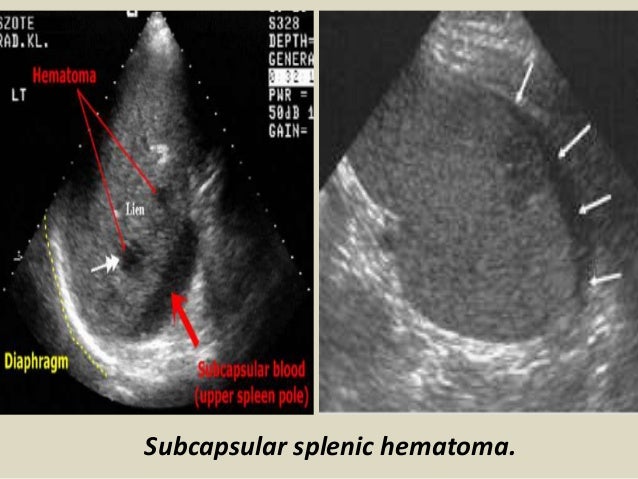 Presentation1.pptx, ultrasound study of the spleen and pancreas.
