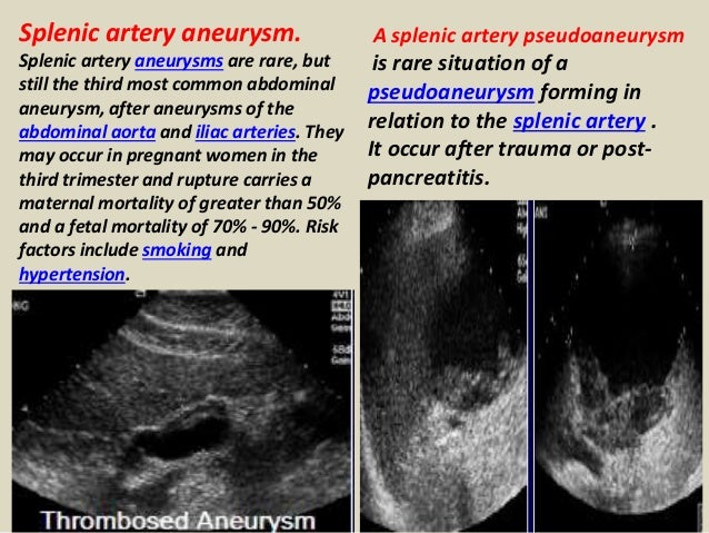 Splenic Artery Ultrasound