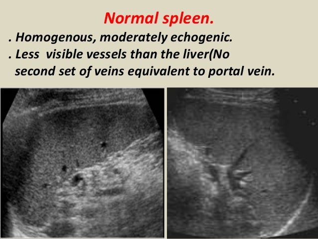 Presentation1.pptx, ultrasound study of the spleen and pancreas.