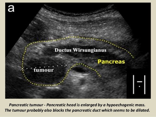 Presentation1.pptx, ultrasound study of the spleen and pancreas.