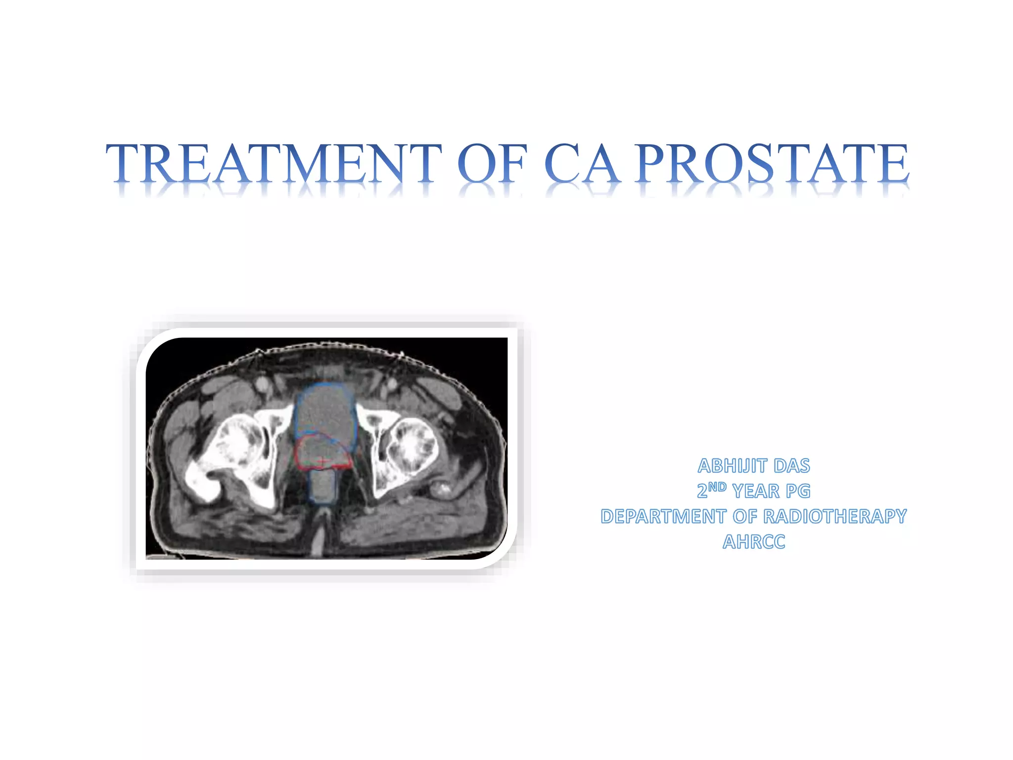 MANAGEMENT OF PROSTATE CA | PPTX