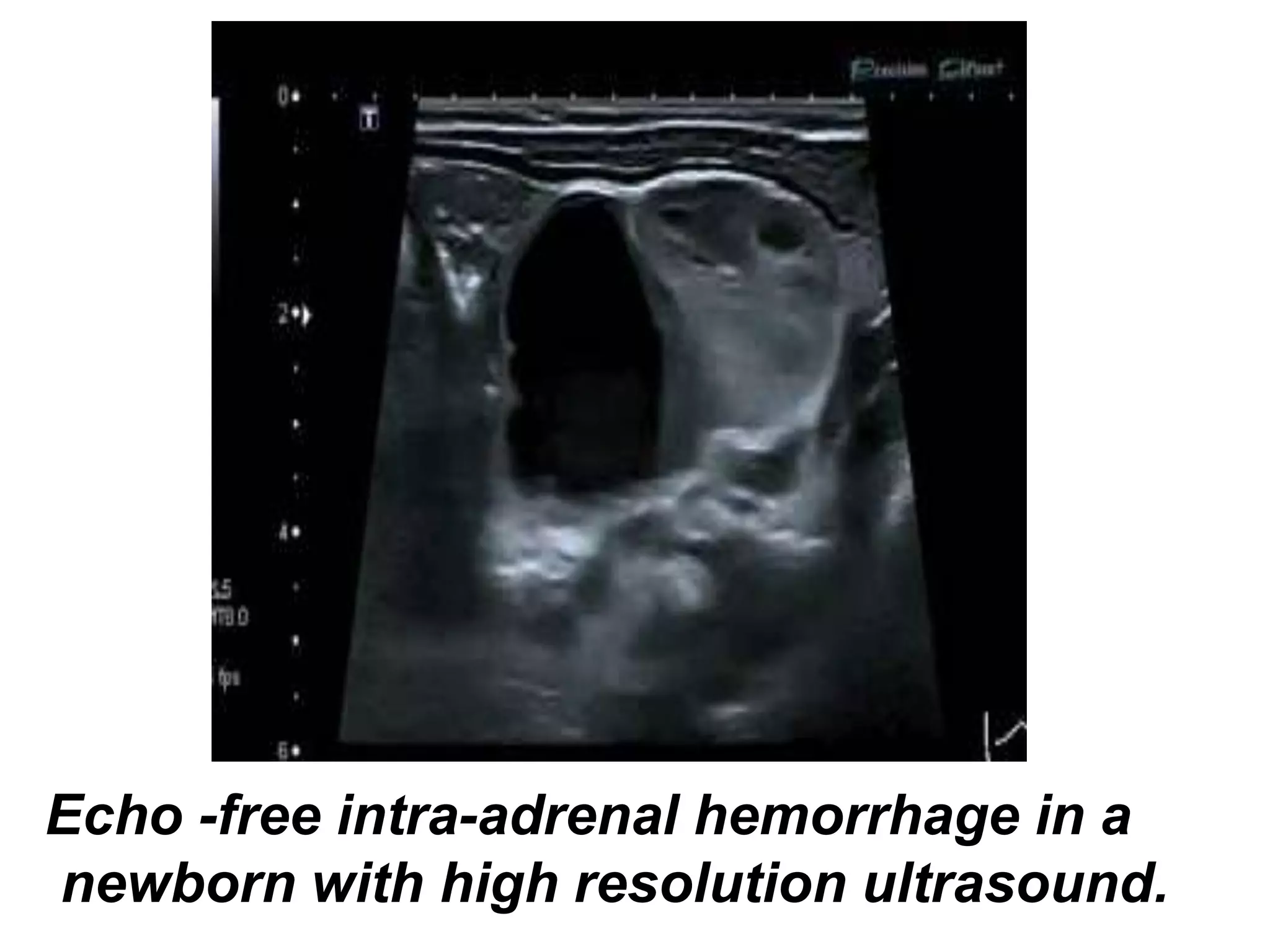 Presentation1.pptx, ultrasound examination of the adrenal glands and ...