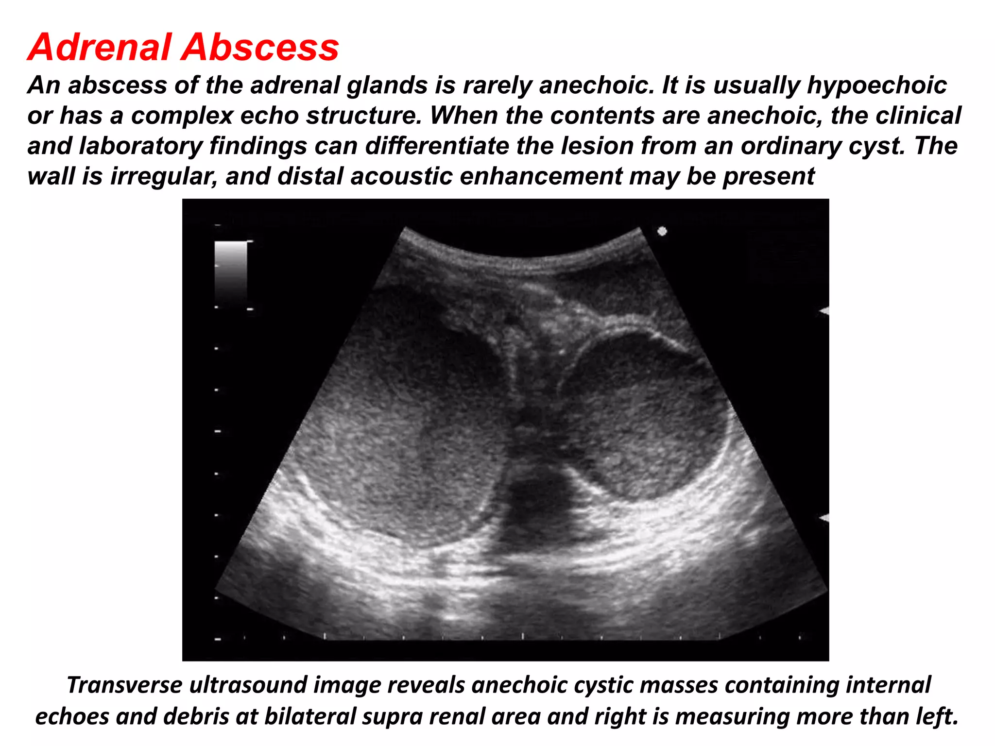 Presentation1.pptx, ultrasound examination of the adrenal glands and ...