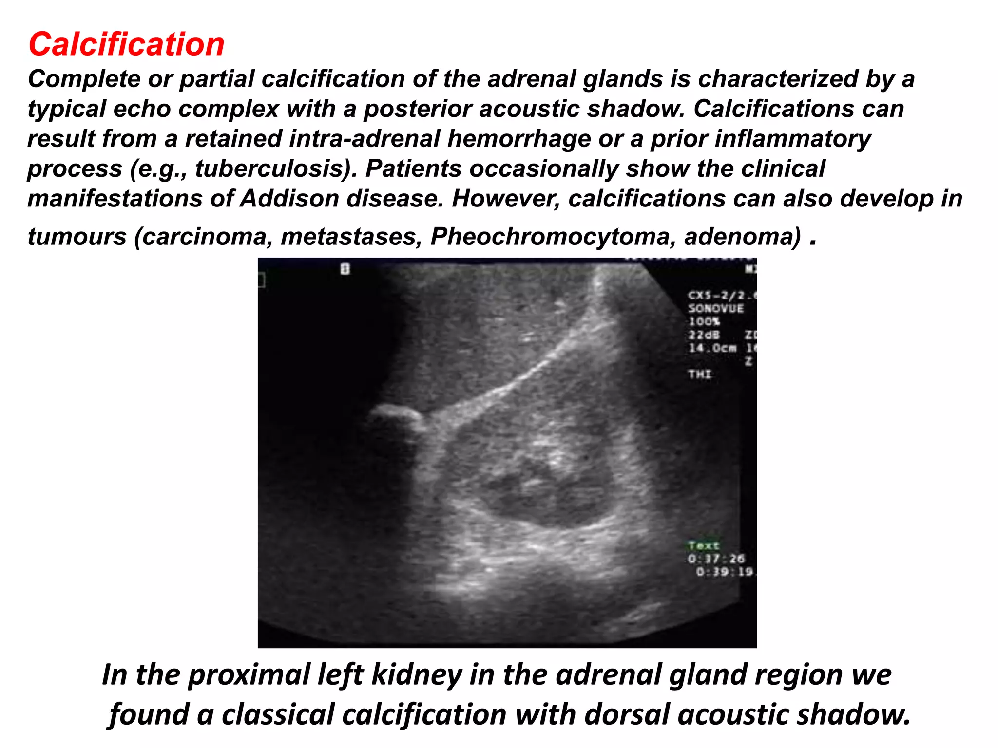 Presentation1.pptx, ultrasound examination of the adrenal glands and ...
