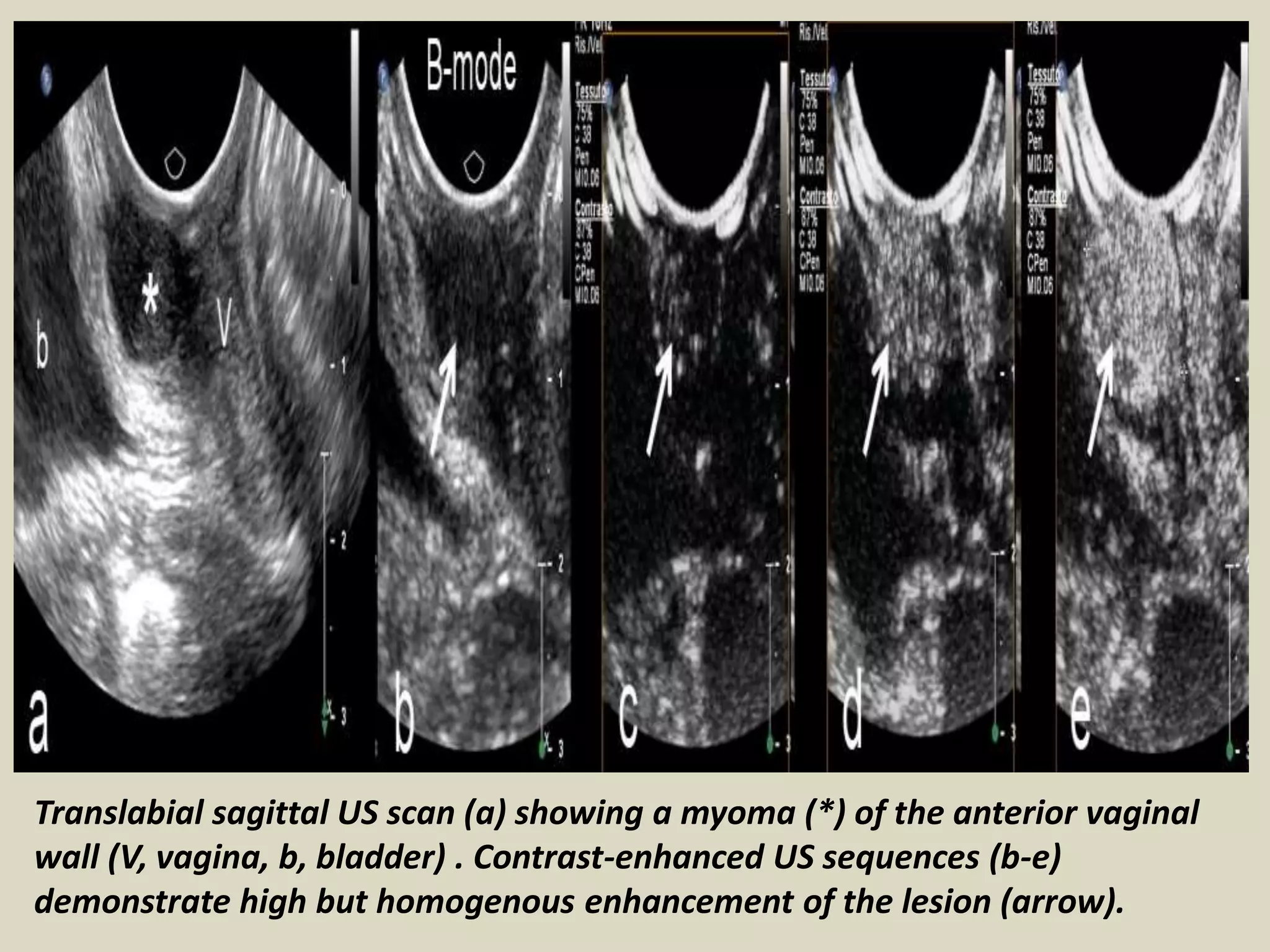 Presentation1.pptx, ultrasound examination of the uterus and ovaries ...