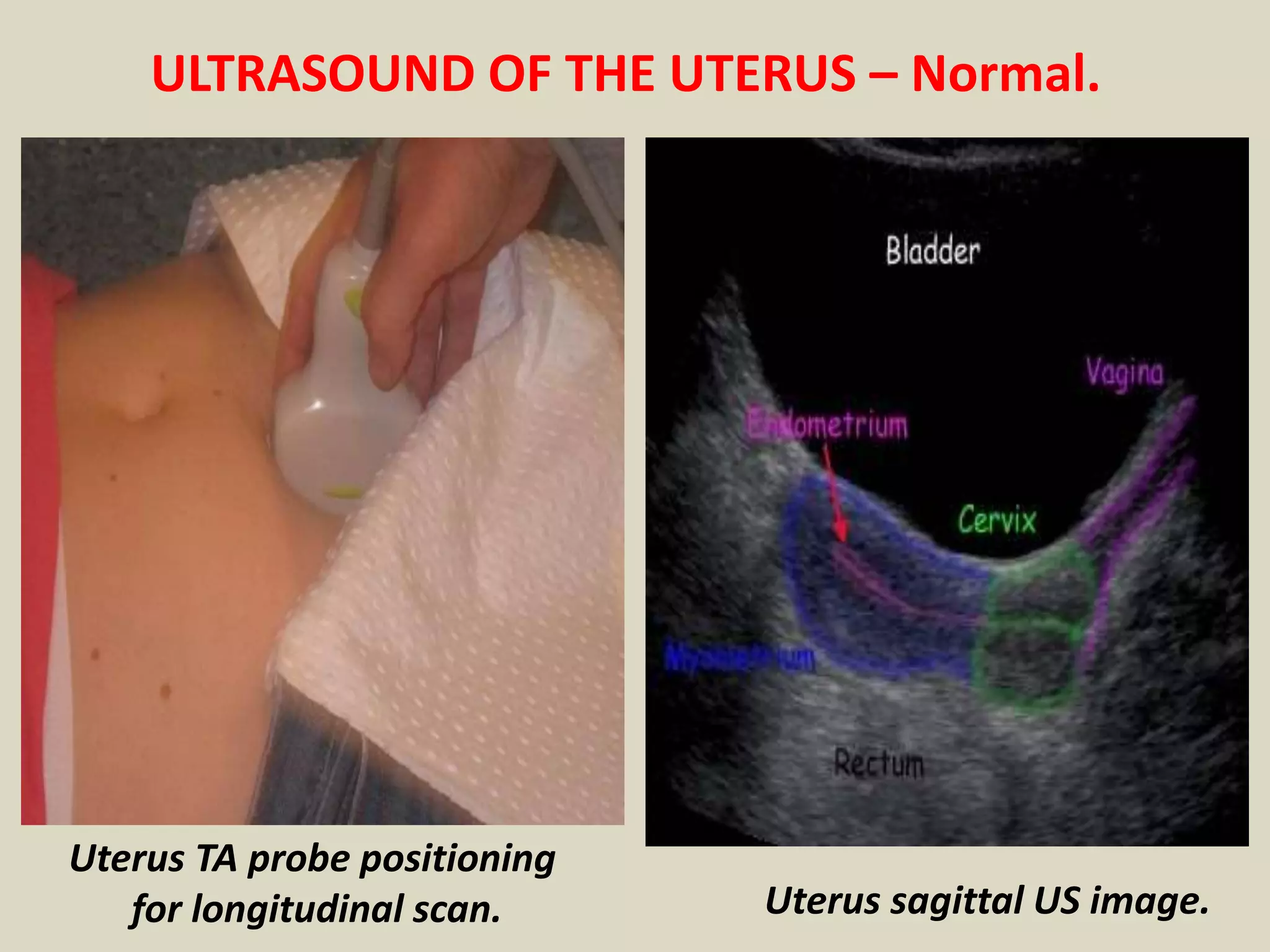 Presentation1.pptx, ultrasound examination of the uterus and ovaries ...