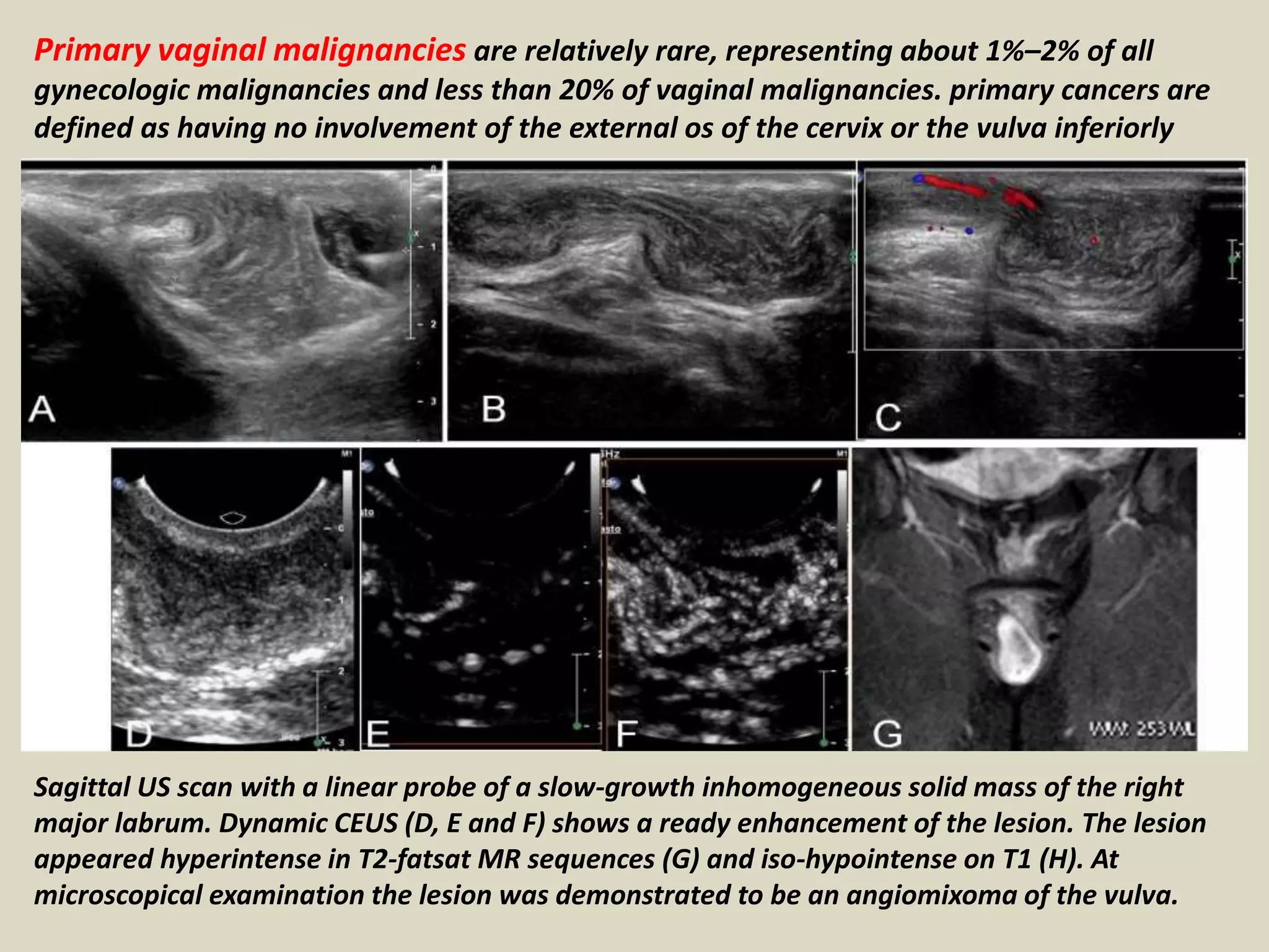 Presentation1.pptx, ultrasound examination of the uterus and ovaries ...