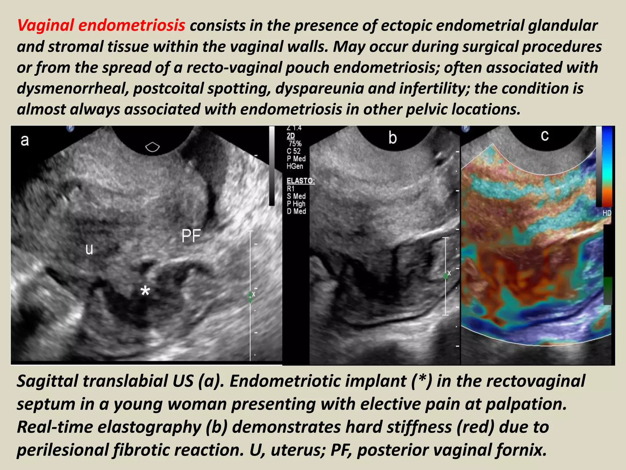 Presentation1.pptx, ultrasound examination of the uterus and ovaries ...
