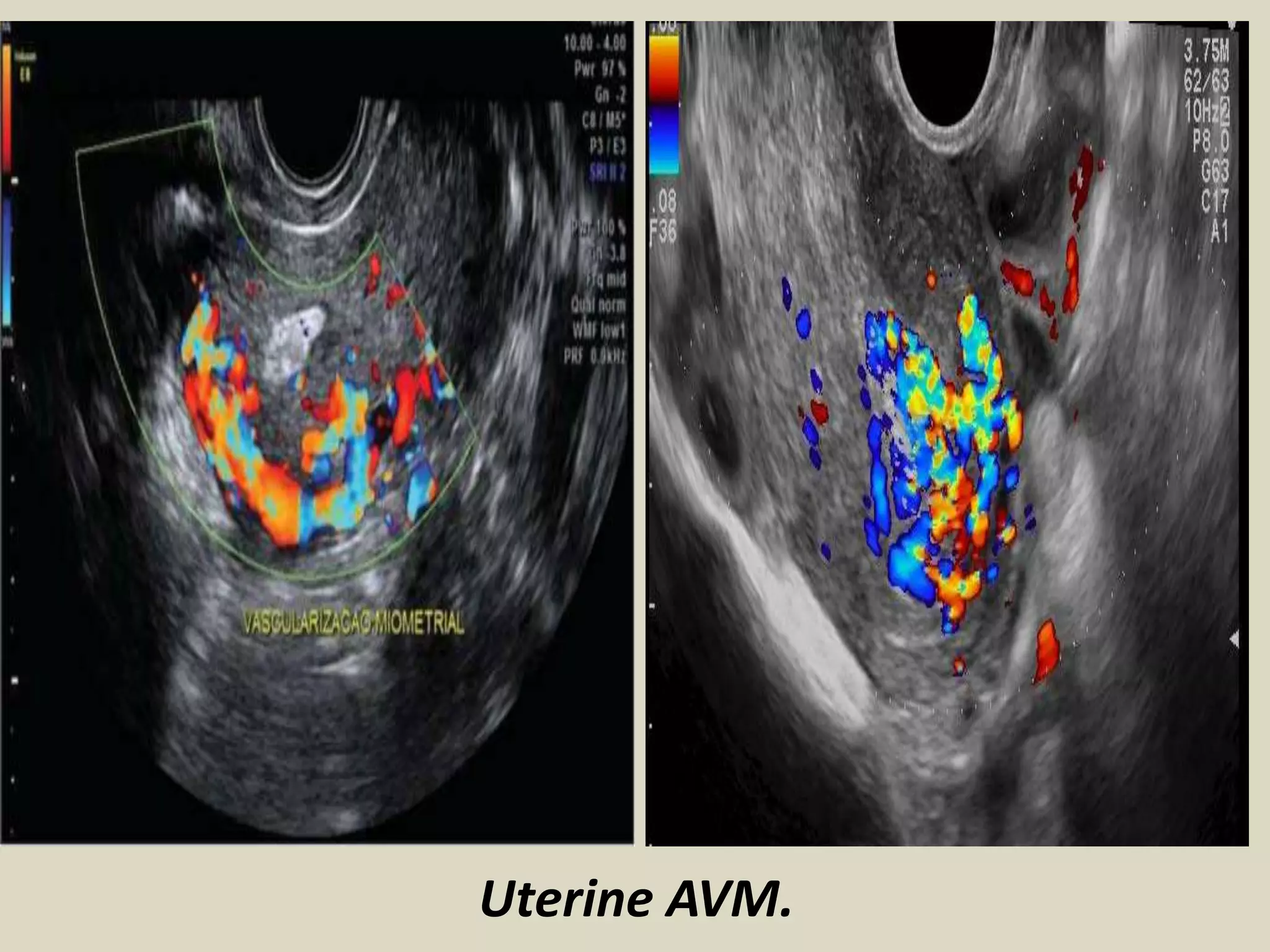 Presentation1.pptx, ultrasound examination of the uterus and ovaries ...