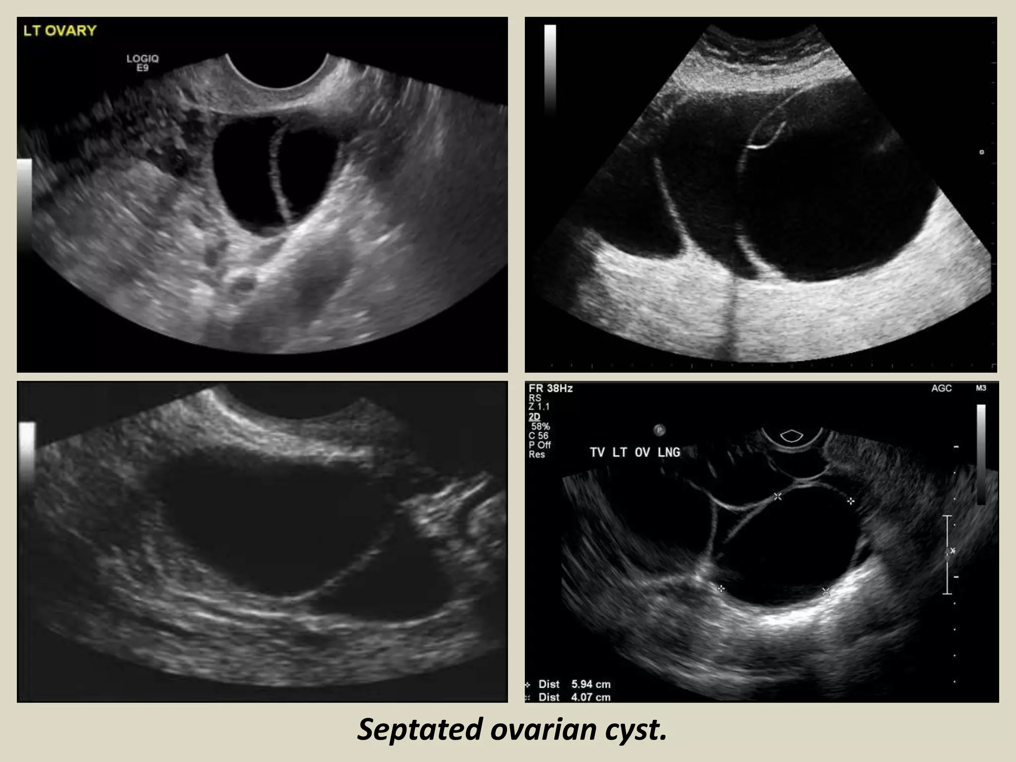 Presentation1.pptx, ultrasound examination of the uterus and ovaries ...