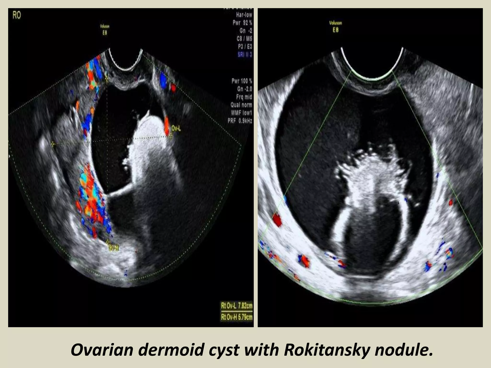 Presentation1.pptx, ultrasound examination of the uterus and ovaries ...