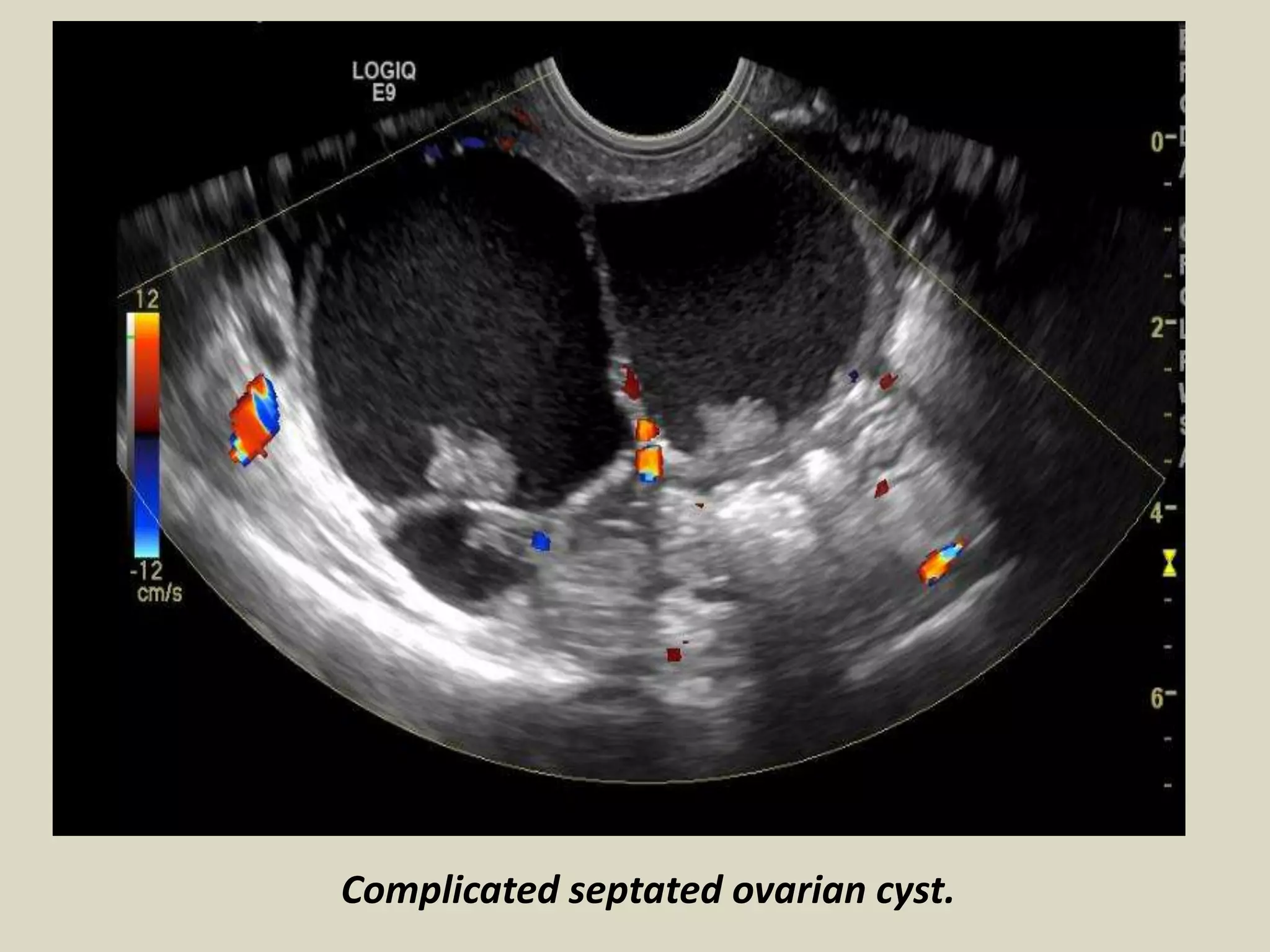 Presentation1.pptx, ultrasound examination of the uterus and ovaries ...