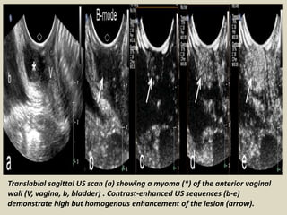 Presentation1.pptx, ultrasound examination of the uterus and ovaries ...