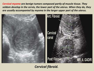 Presentation1.pptx, ultrasound examination of the uterus and ovaries ...