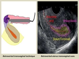 Presentation1.pptx, ultrasound examination of the uterus and ovaries ...