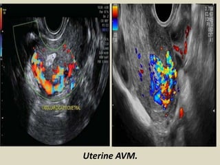 Presentation1.pptx, ultrasound examination of the uterus and ovaries ...