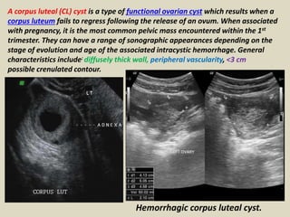 Presentation1.pptx, ultrasound examination of the uterus and ovaries ...
