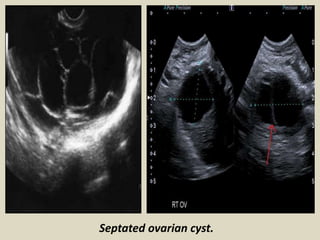 Presentation1.pptx, ultrasound examination of the uterus and ovaries ...