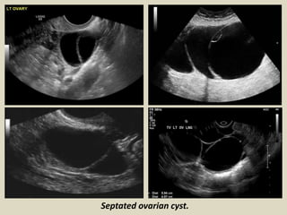 Presentation1.pptx, ultrasound examination of the uterus and ovaries ...