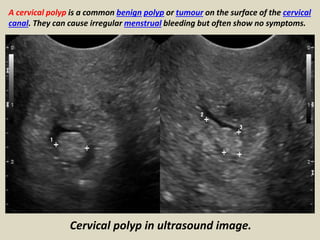 Cervical Polyps Ultrasound