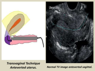 Anteverted Uterus Ultrasound