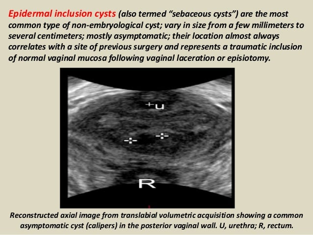 Inclusion Cyst On Vaginal Wall – MTSIVC