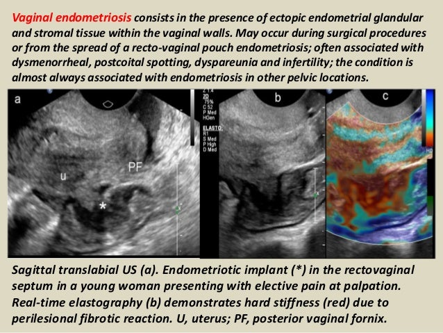 Fornix Uterus