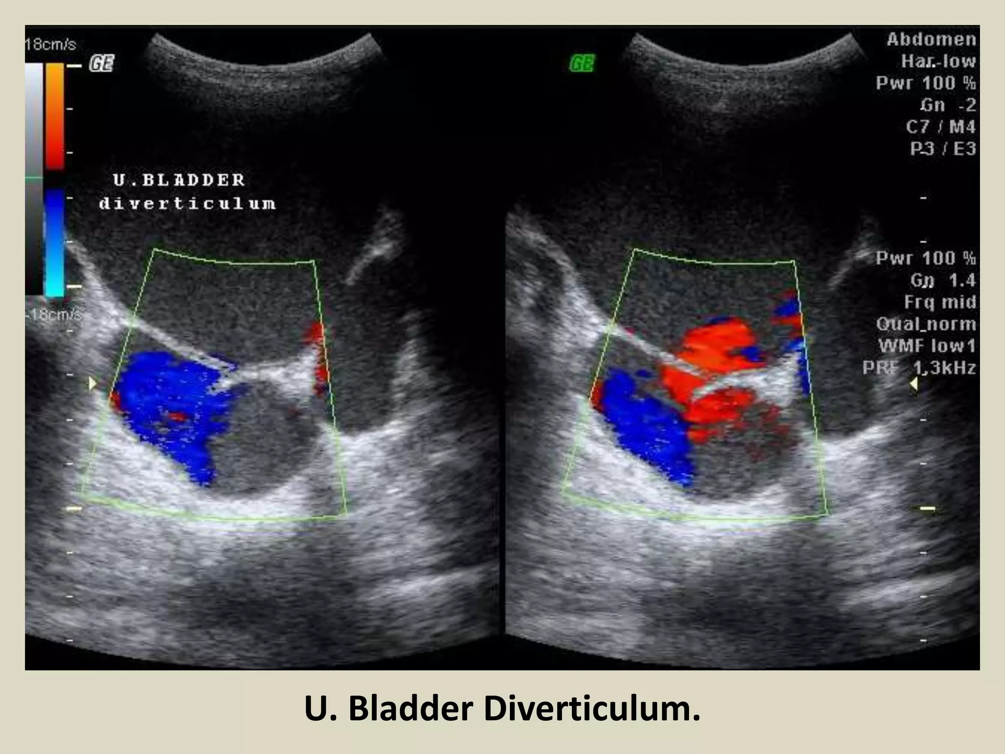 Presentation1.pptx, ultrasound examination of the urinary bladder and ...