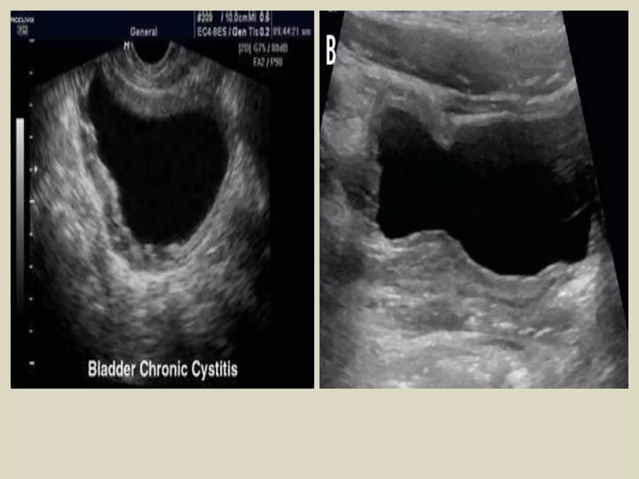 Presentation1.pptx, ultrasound examination of the urinary bladder and ...