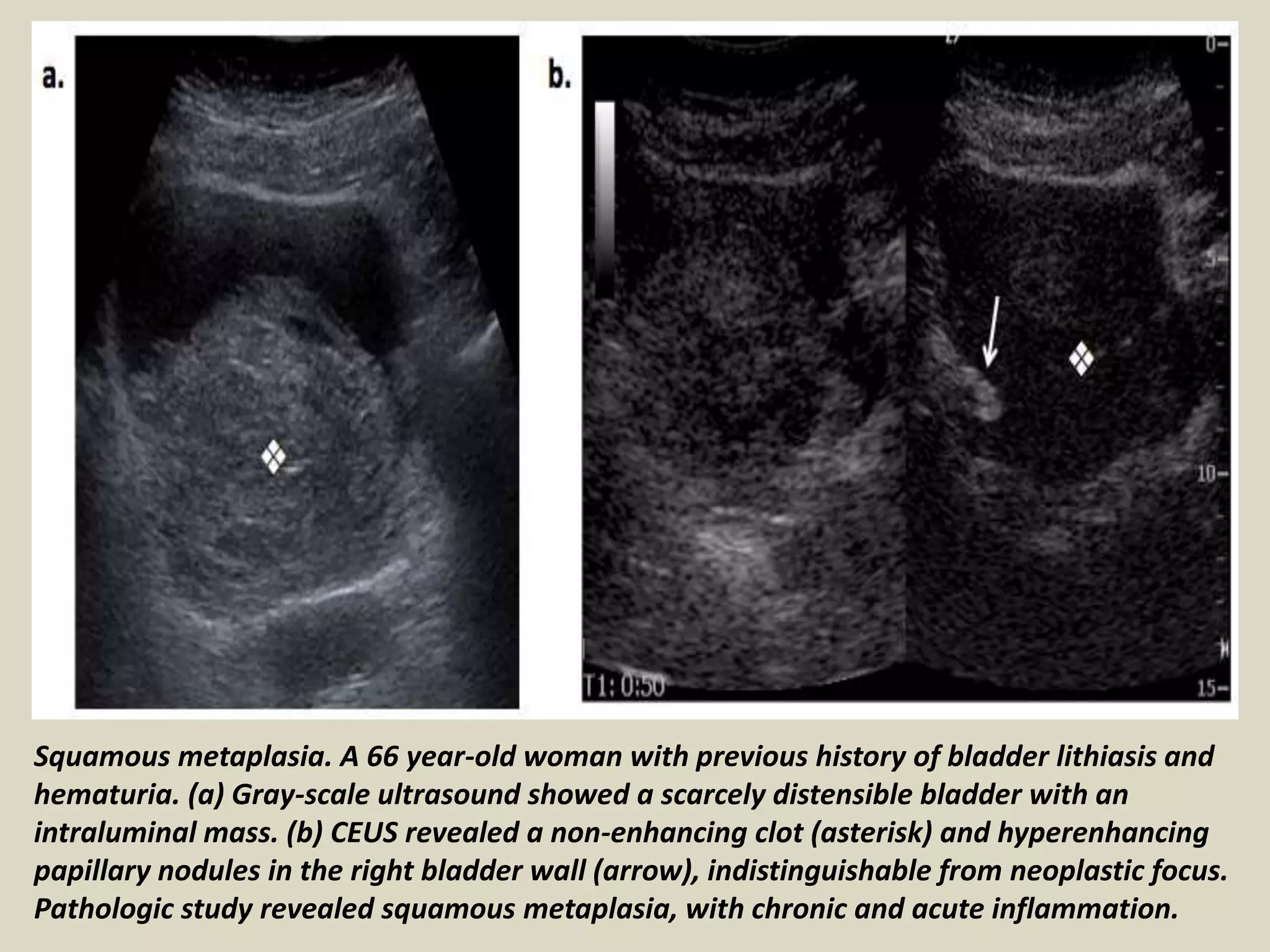 Presentation1.pptx, ultrasound examination of the urinary bladder and ...