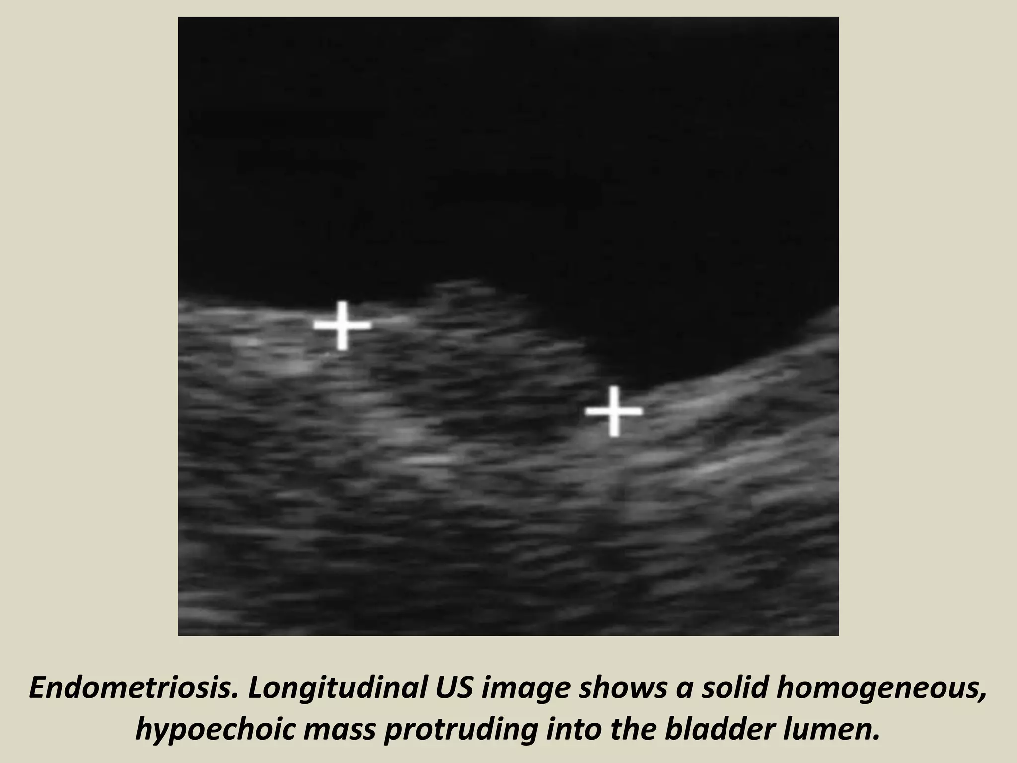 Presentation1.pptx, ultrasound examination of the urinary bladder and ...
