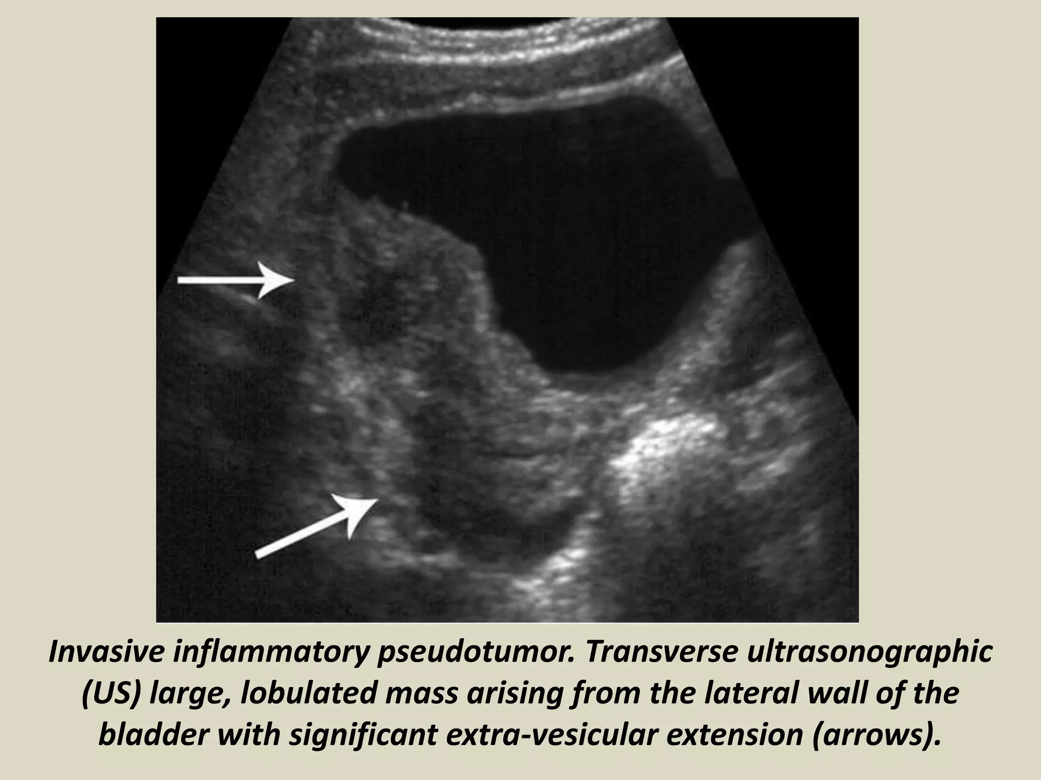 Presentation1.pptx, ultrasound examination of the urinary bladder and ...