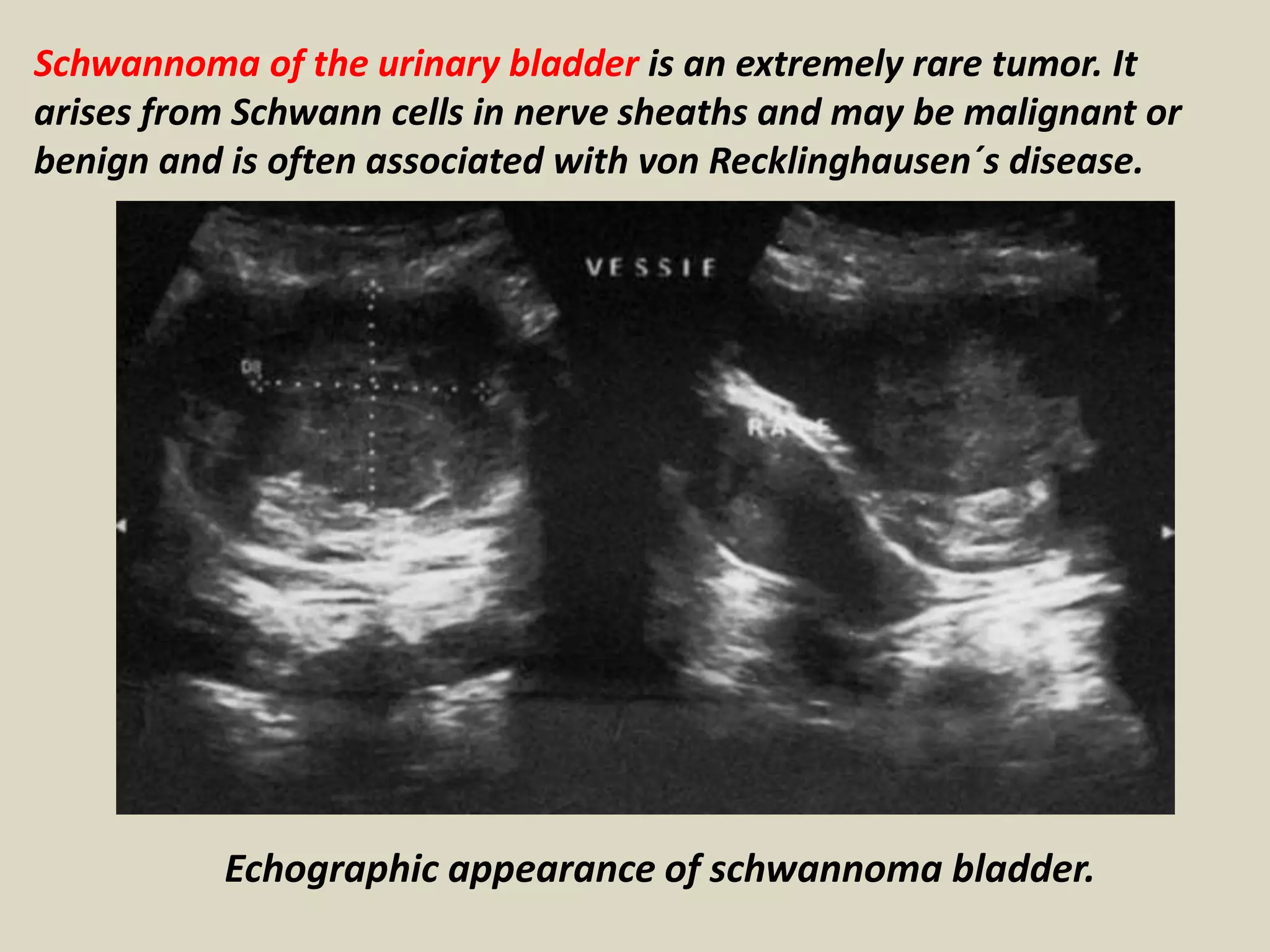 Presentation1.pptx, ultrasound examination of the urinary bladder and ...