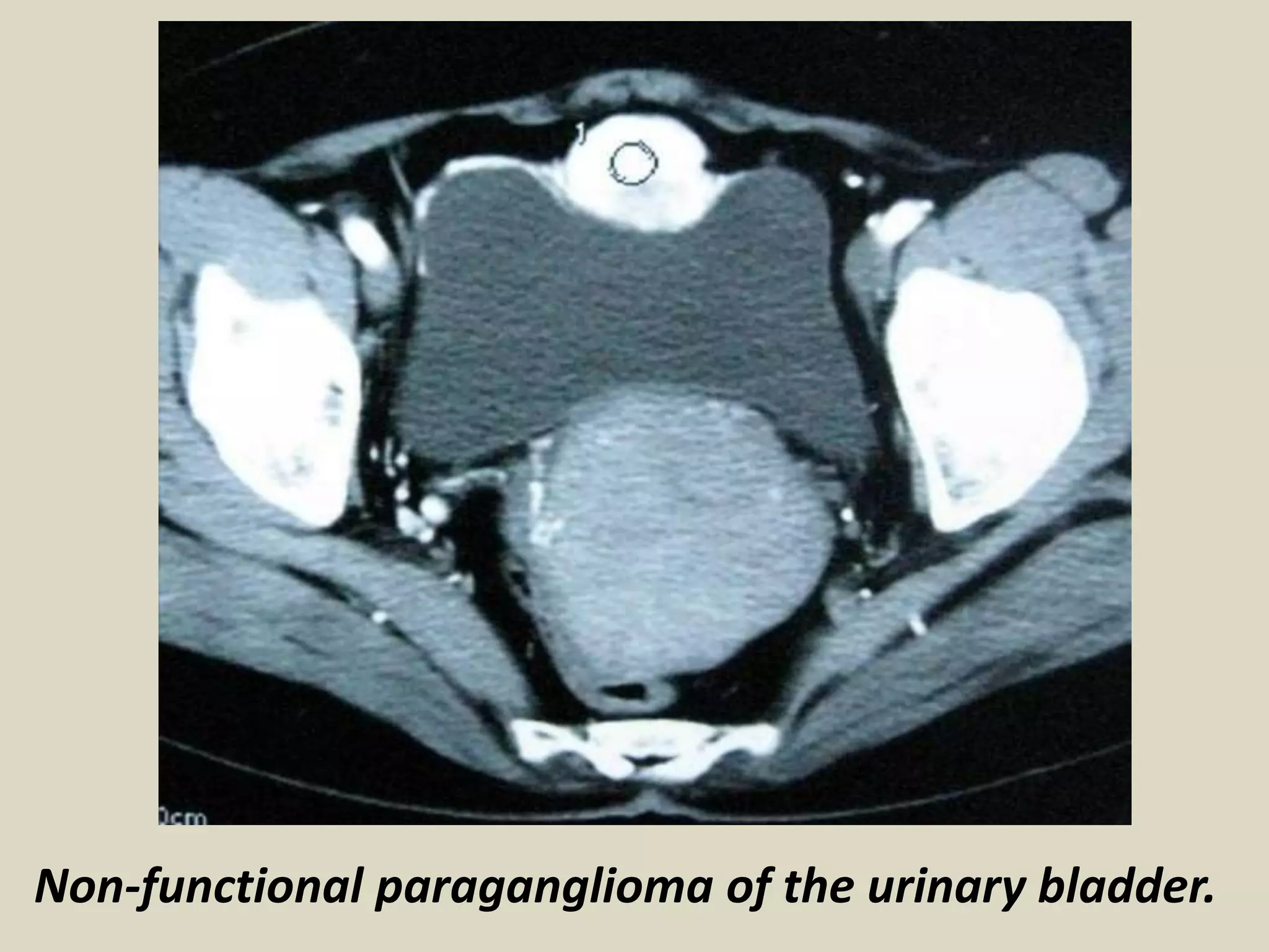 Presentation1.pptx, ultrasound examination of the urinary bladder and ...