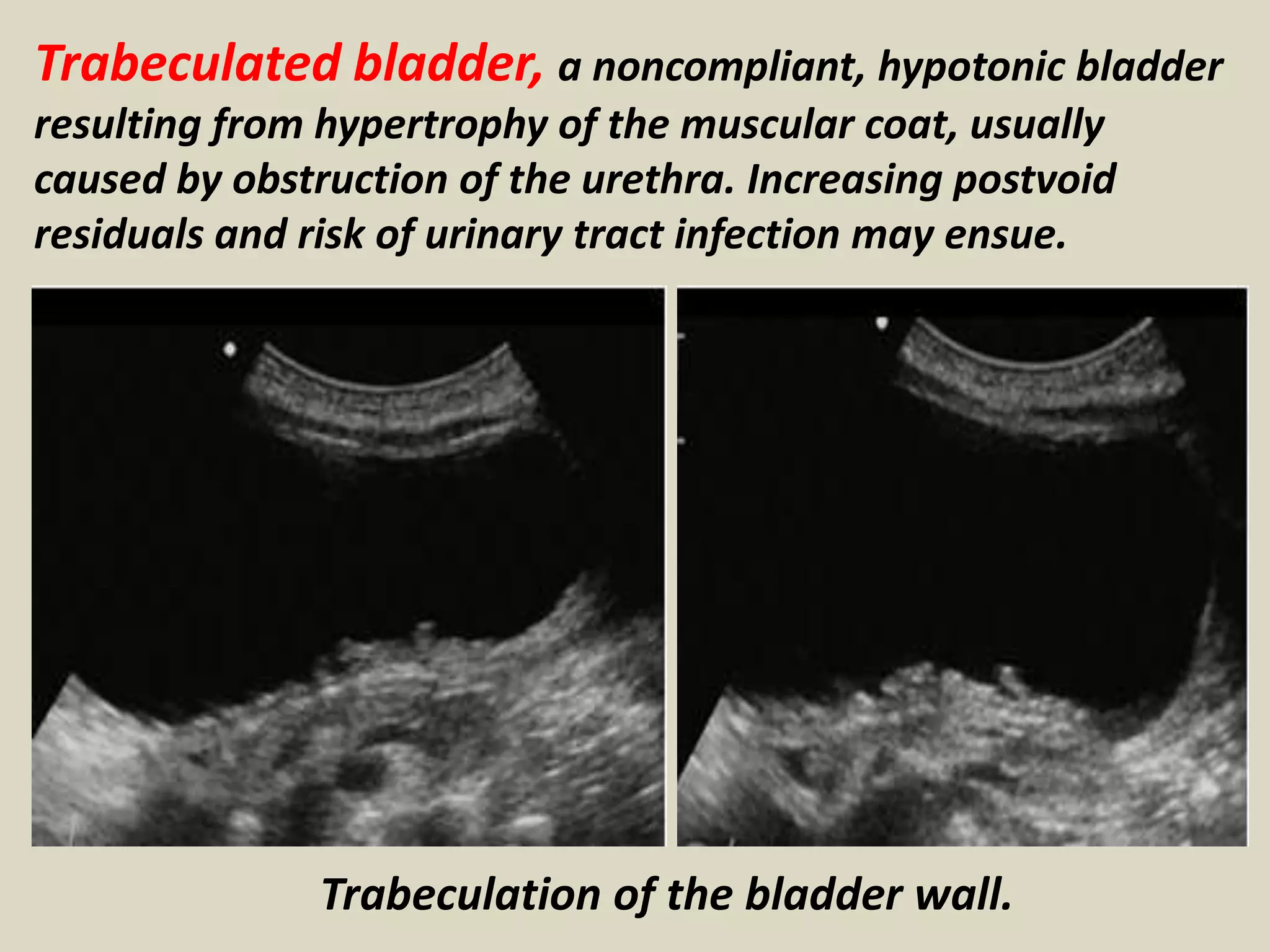 Presentation1.pptx, ultrasound examination of the urinary bladder and ...