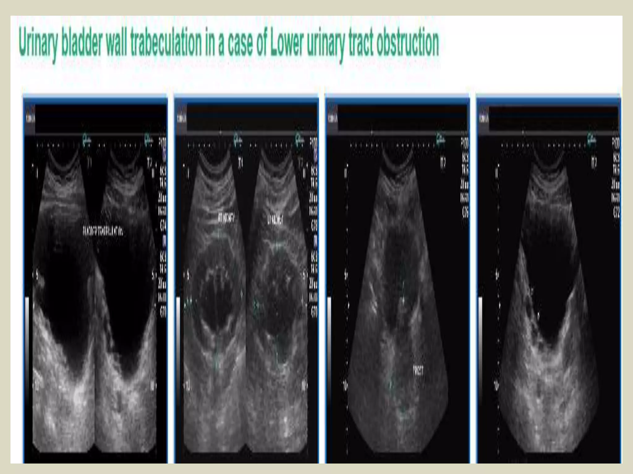 Presentation1.pptx, ultrasound examination of the urinary bladder and ...