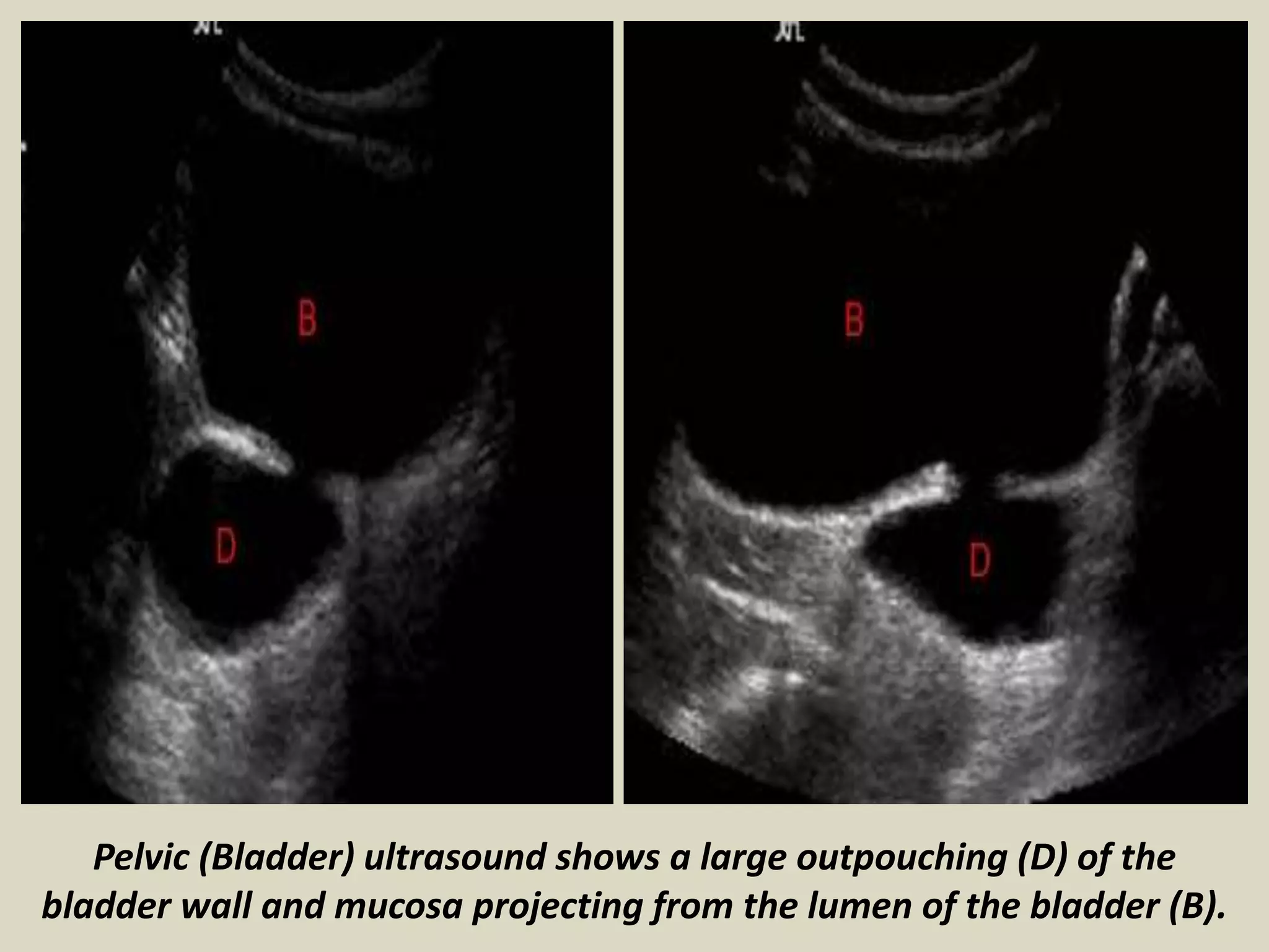 Presentation1.pptx, ultrasound examination of the urinary bladder and ...