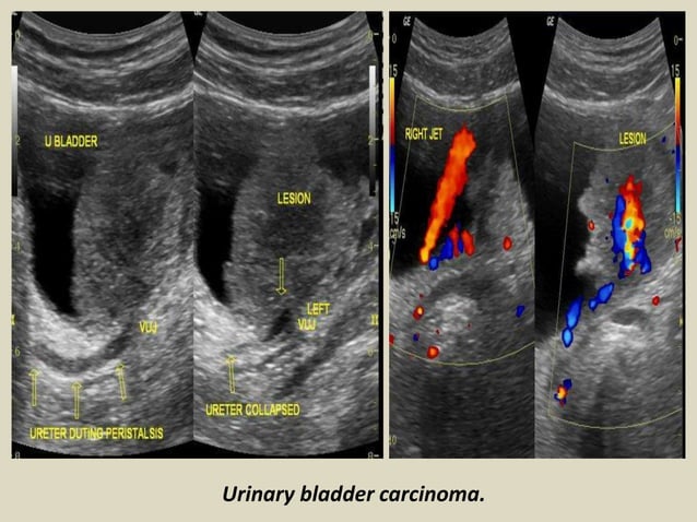 Presentation1.pptx, ultrasound examination of the urinary bladder and ...
