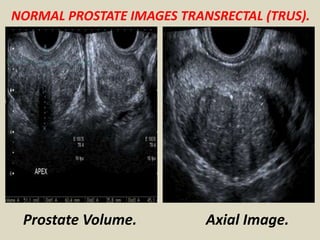 Presentation1.pptx, ultrasound examination of the urinary bladder and ...