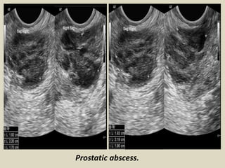 Presentation1.pptx, ultrasound examination of the urinary bladder and ...