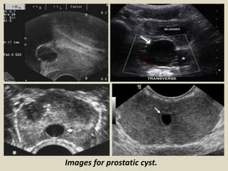 Presentation1.pptx, ultrasound examination of the urinary bladder and ...