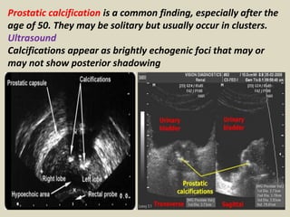 Presentation1.pptx, ultrasound examination of the urinary bladder and ...