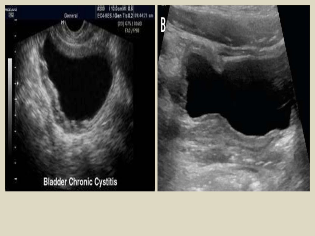Presentation1.pptx, ultrasound examination of the urinary bladder and…