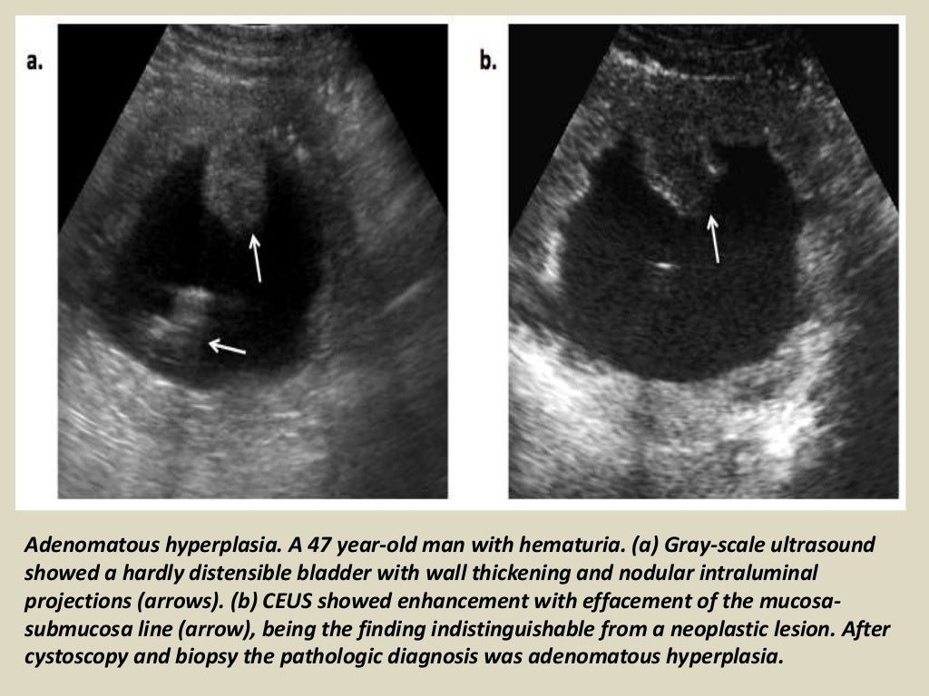 Presentation1pptx Ultrasound Examination Of The Urinary Bladder And
