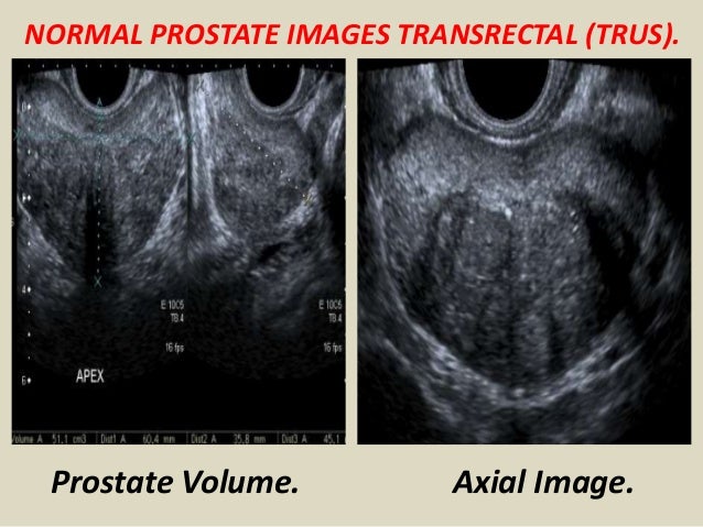 Presentation1.pptx, ultrasound examination of the urinary bladder and…
